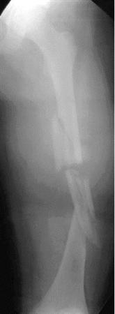 Femoral Shaft Fractures - Pediatric - Pediatrics - Orthobullets